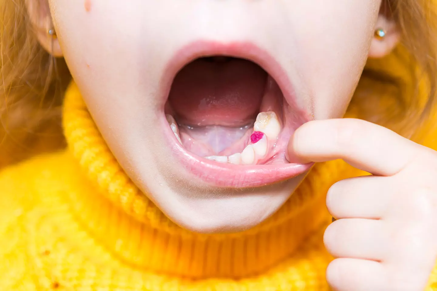 Tooth Colored Fillings Finesse Dental Care North Aurora