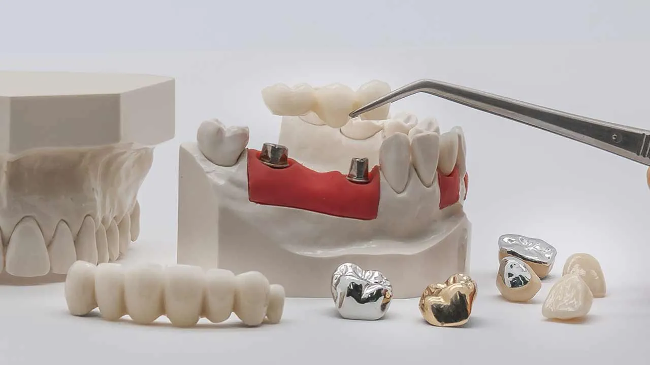 Temporary vs. Permanent Dental Crowns: What You Need to Know | Varni Dental